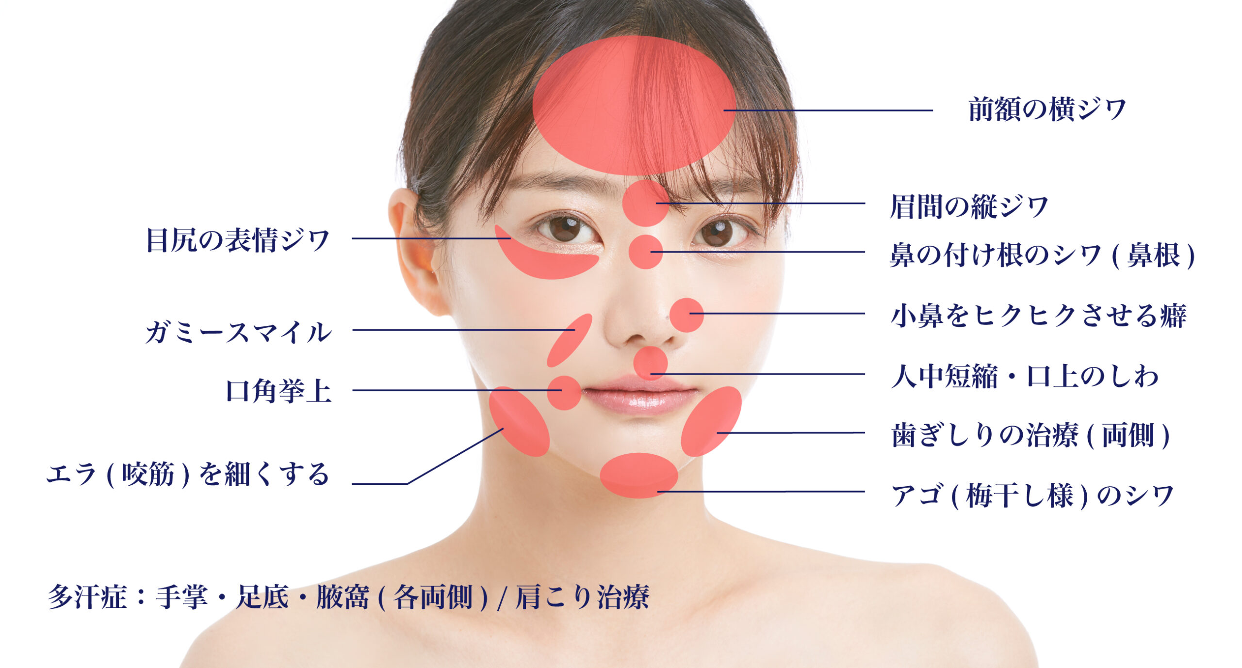 ボトックス注射